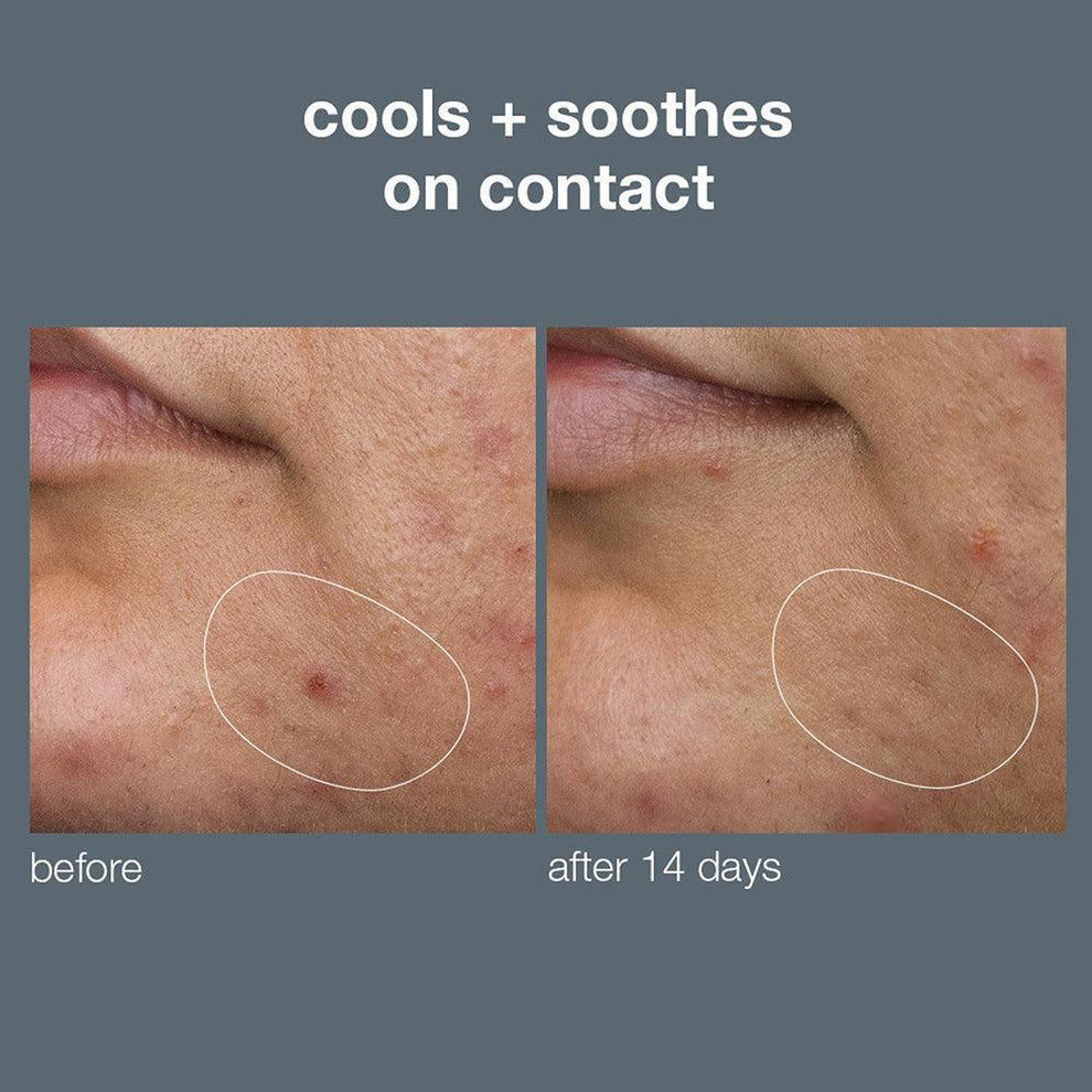 deep breakout invisible liquid patch – Dermalogica Malaysia
